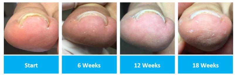 Onyfix (Nail Bracing) | Lidcombe Podiatry