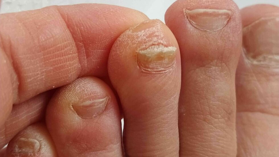 Are Ingrown Toenails Different From Toenail Fungus? Symptoms, Causes ...