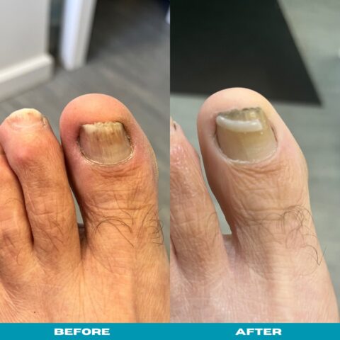 Onyfix (Nail Bracing) | Lidcombe Podiatry