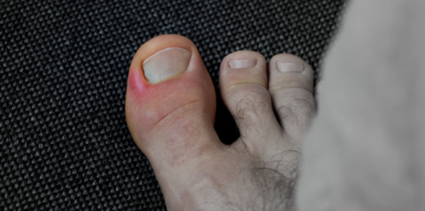 Paronychia Vs Ingrown Toenails: Understanding Cause and Treatments ...